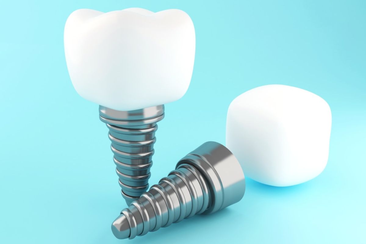 Smile Restoration with Implants | Get custom dental implants