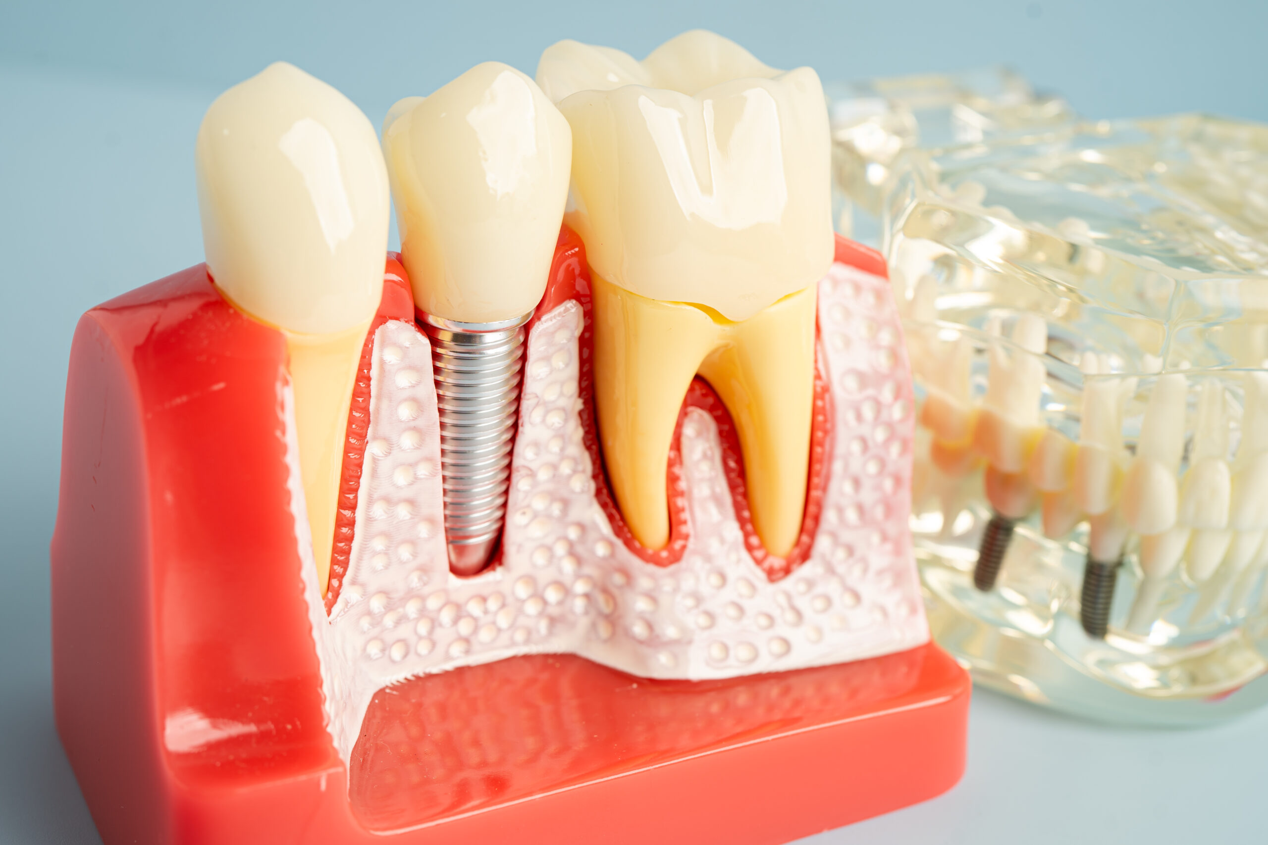 Dental Implants in Tucson: Expert Answers to Common Questions